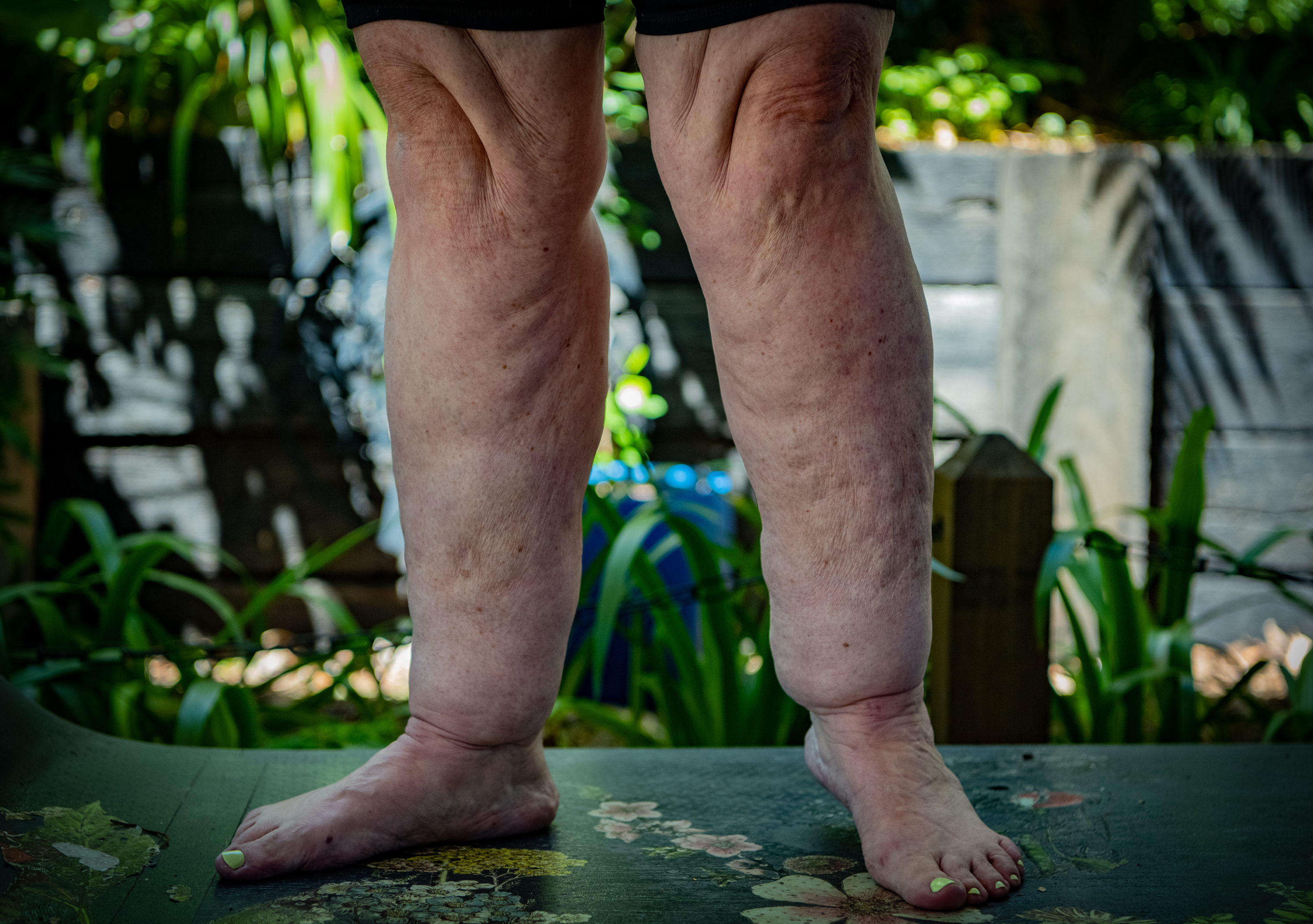 This is life with lipoedema: these women have a powerful message to ...